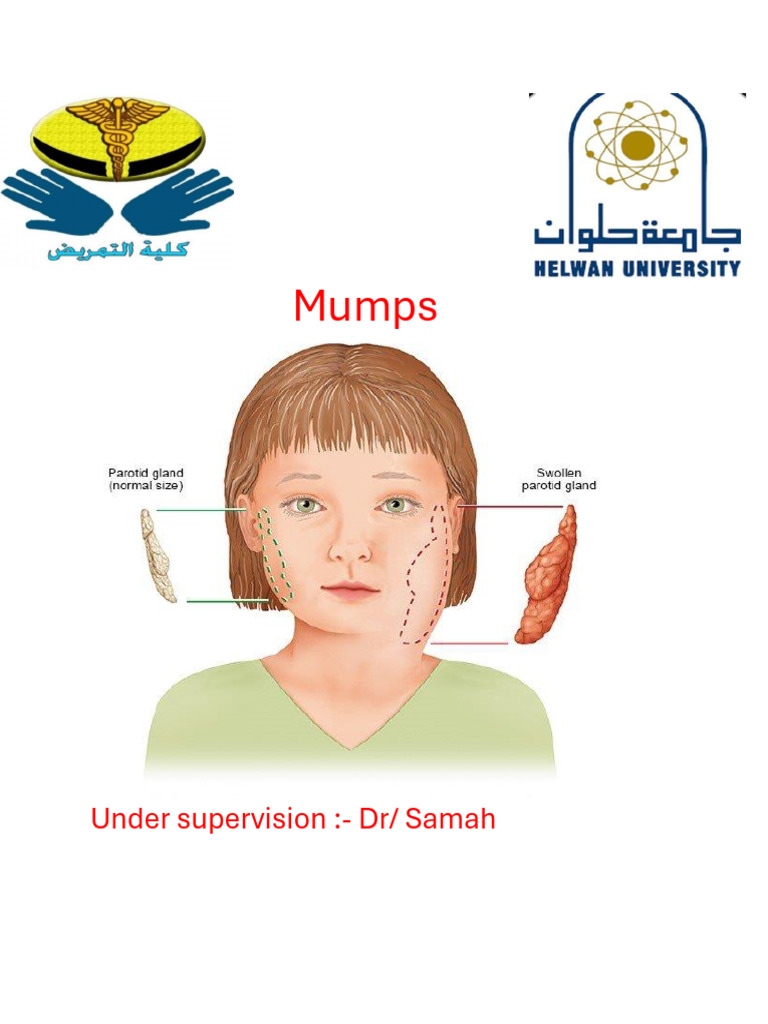 بحث mumps | PDF | Clinical Medicine | Medicine