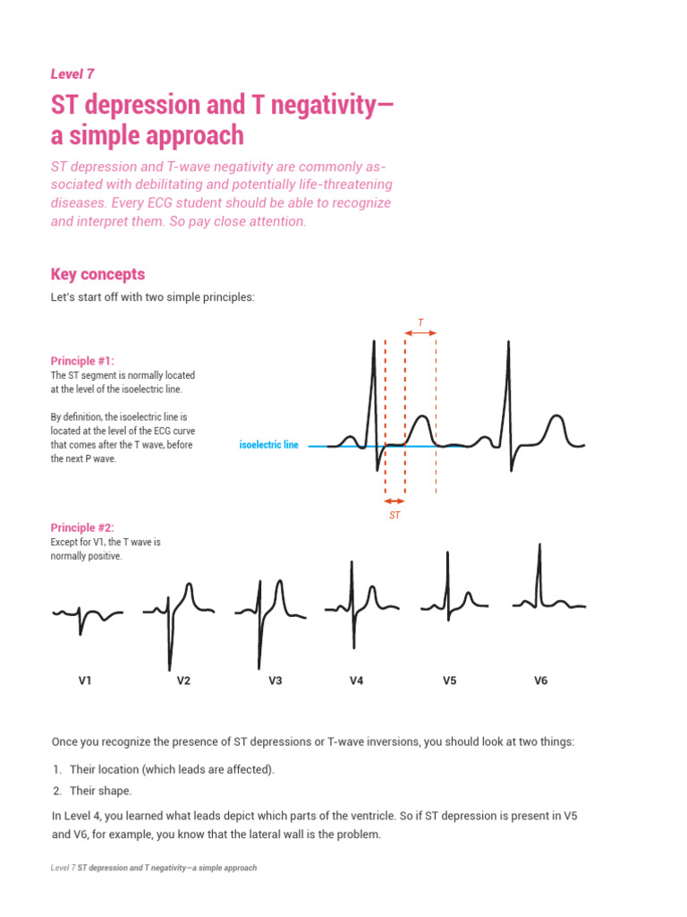 Understanding ST Depression and T Negativity | PDF | Cardiac ...