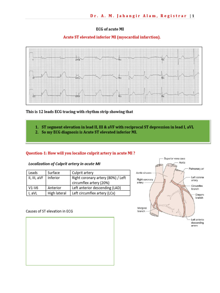 ECG of Acute MI | PDF | Myocardial Infarction | Percutaneous Coronary ...
