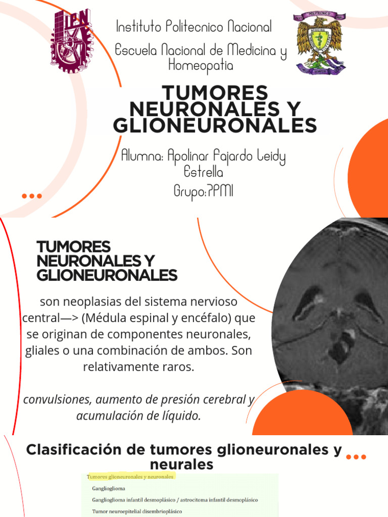 TUMORES NEURONALES Y Glioneuronales | PDF | Neoplasias | Epilepsia