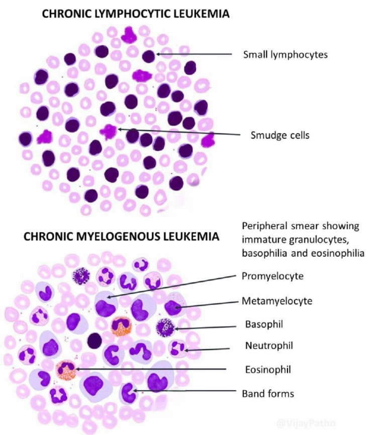 Diagrams Chronic Lukemia | PDF