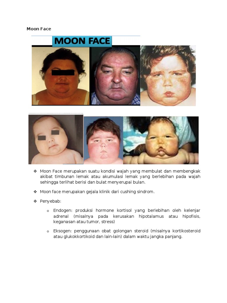 Moon Face, Face Swelling, Dan Plethoric Face | PDF