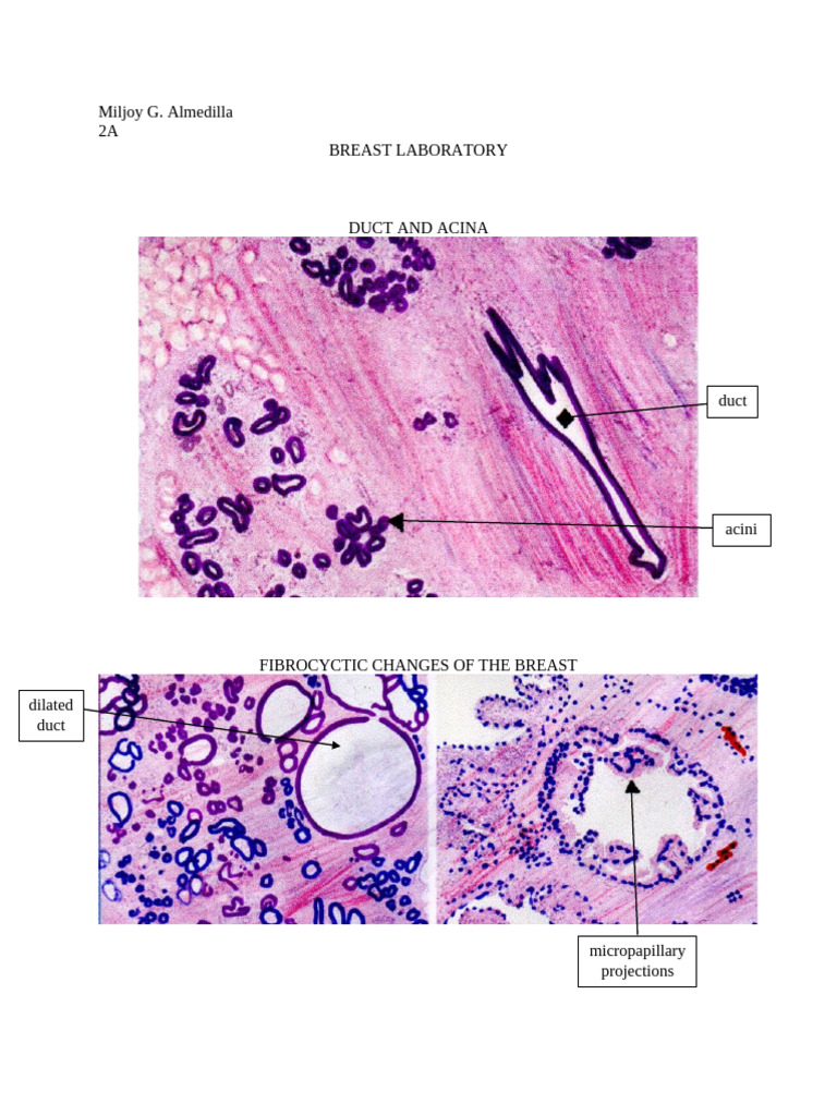 2A Almedilla, Miljoy G. Breast Lab | PDF
