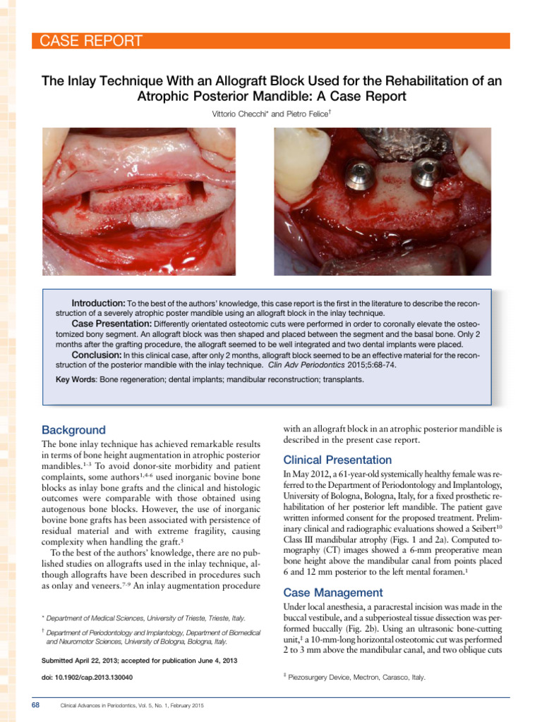 Injero inlay (Checchi 2015) | PDF | Dental Implant | Medical Specialties