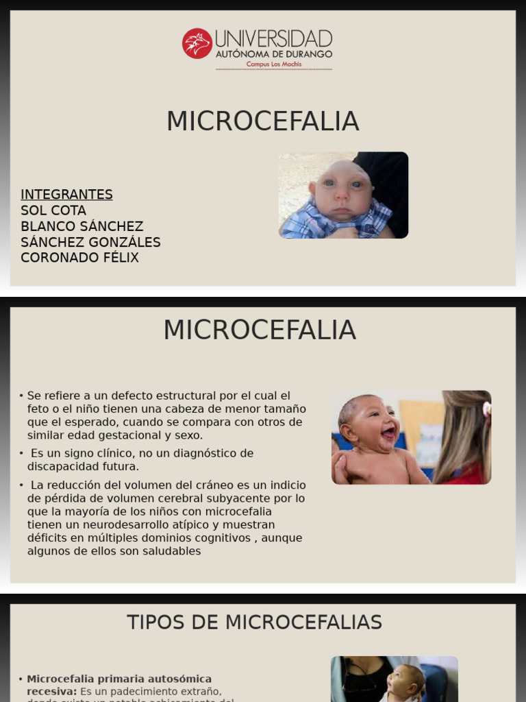 Microcefalia: Tipos, Diagnóstico y Complicaciones | PDF | Cerebro ...