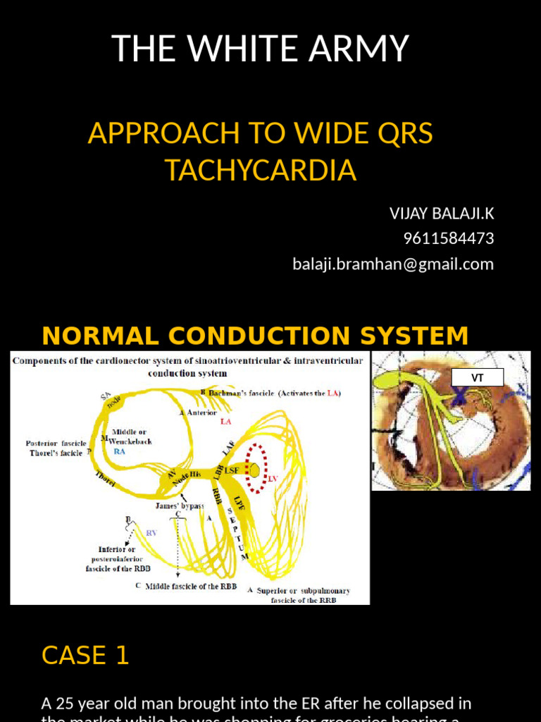 Wide QRS Tachycardia Diagnosis Guide | PDF | Electrocardiography ...