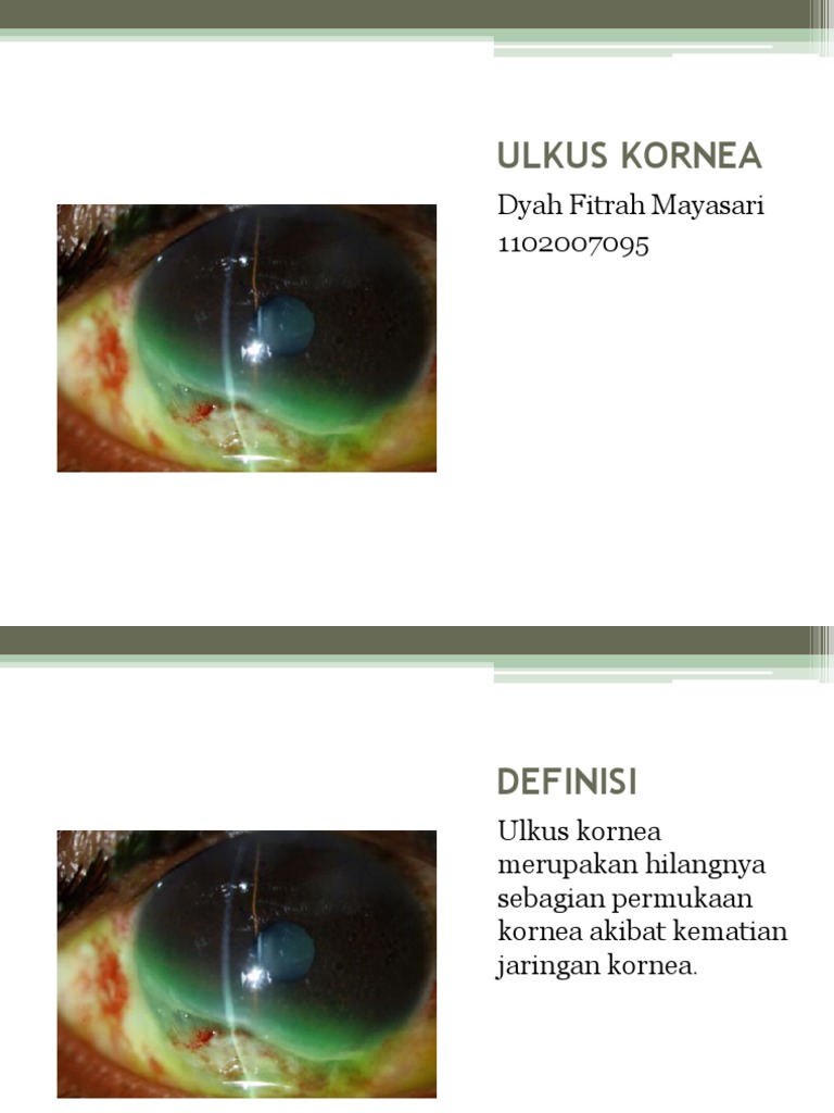 Ulkus Kornea dan Hipopion | PDF | Sains & Matematika
