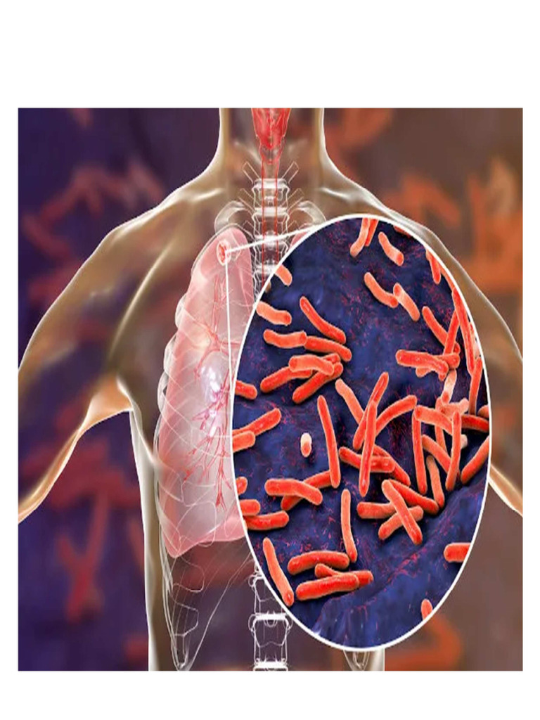 Tuberculose - Pulmonar Corrigida | PDF