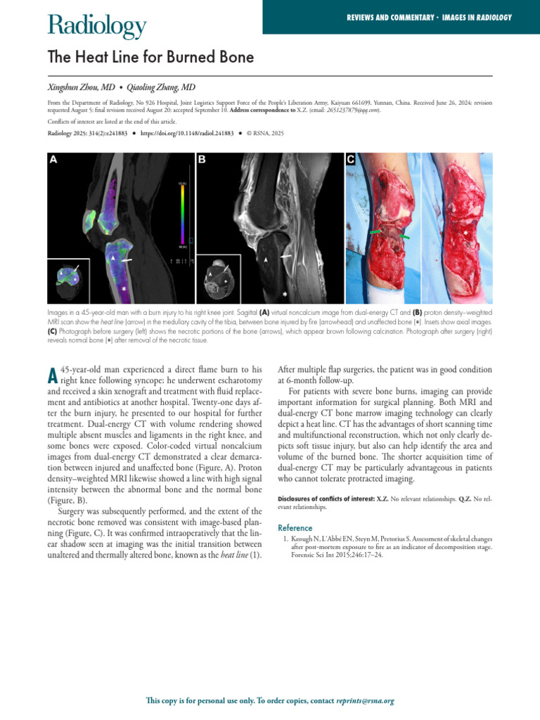 The Heat Line For Burned Bone | PDF | Ct Scan | Radiology