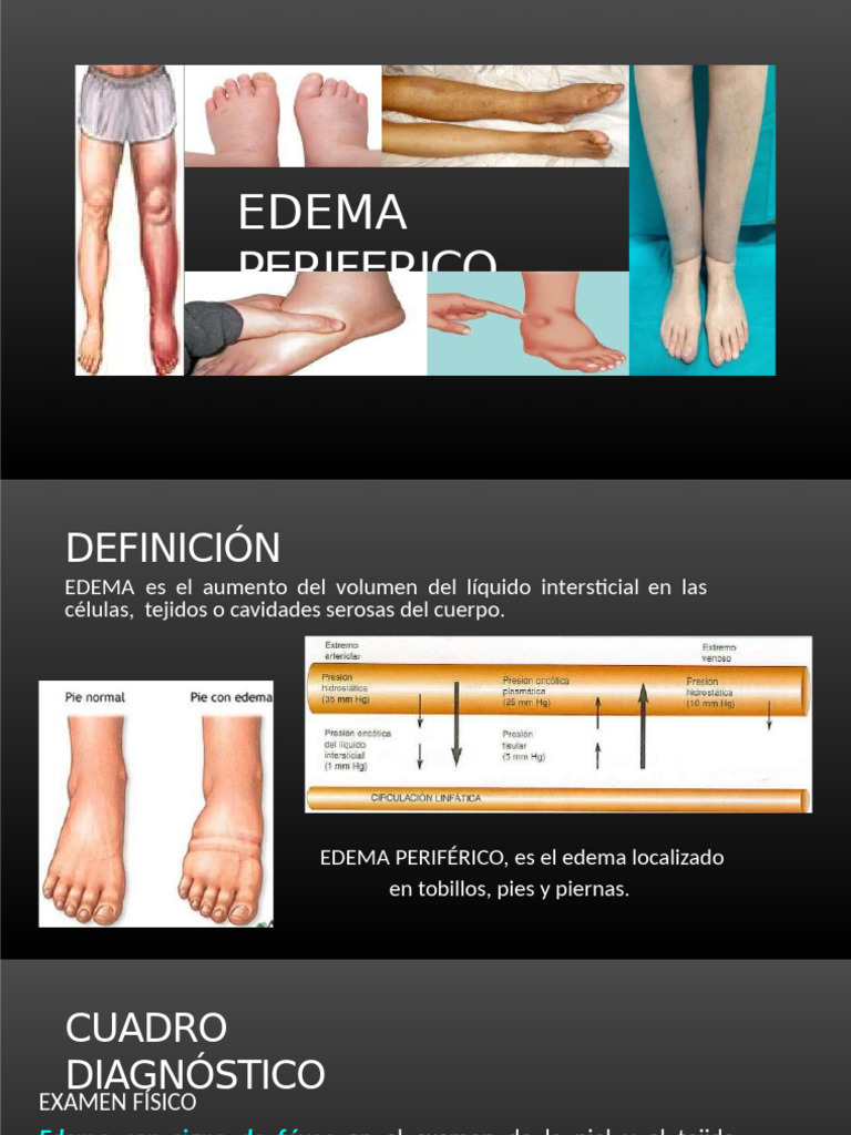 Edema Periferico Semiología | PDF