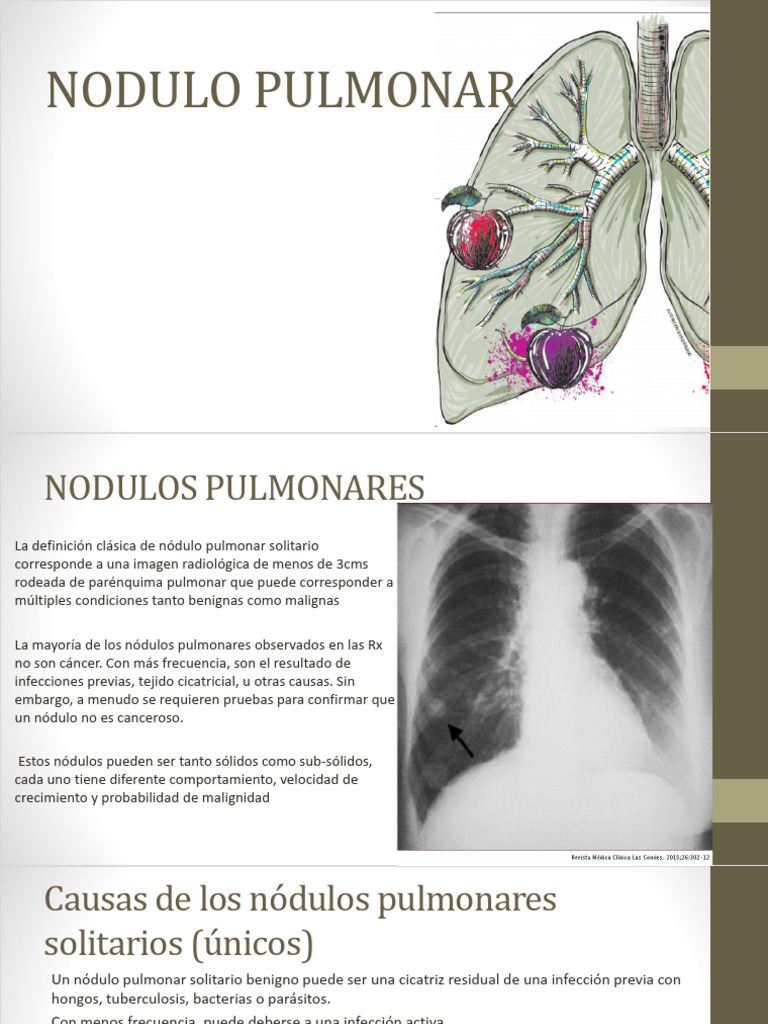 Nódulos Pulmonares: Causas y Tratamientos | PDF