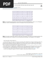 Ecg Interpretation J Point Stemi Criteria Equivalents and Others | PDF ...