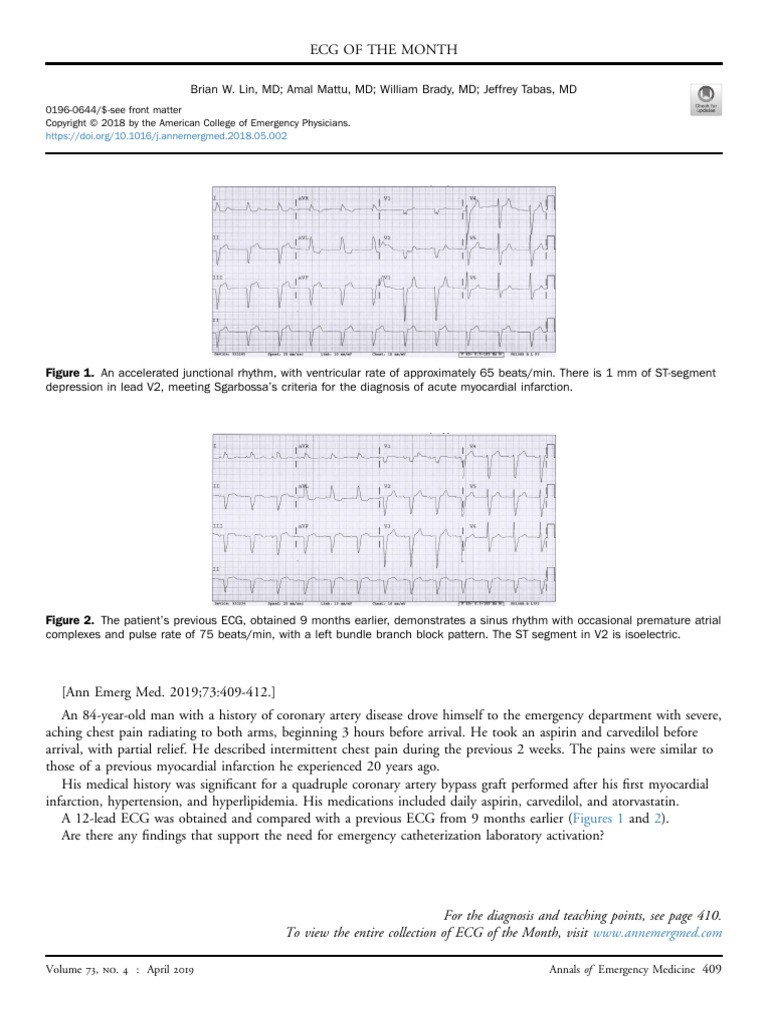 A Single Lead of Concordant ST Deviation in Left B | PDF ...