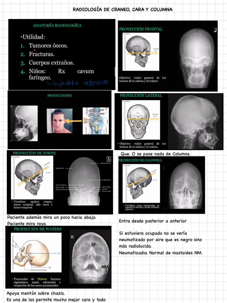 RX Craneo Y Columna, ACV Isquémico Y Hemorragico. | PDF | Vértebra | Carrera