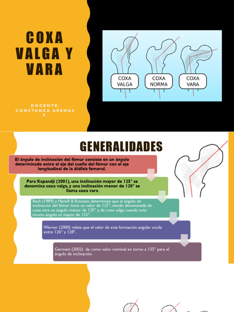 Coxa Valga y Vara: Definición y Tratamiento | PDF | Sistema esquelético ...
