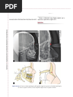 Cranial Lines and Fractures Overview | PDF | Skull | Human Head And Neck