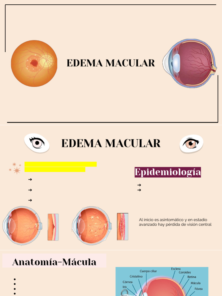 Edema Macular: Causas y Tratamientos | PDF | Percepción visual | Retina