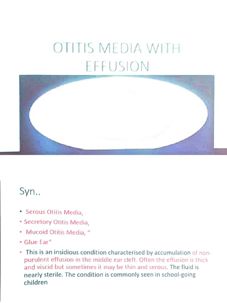 Otitis Media & Effusion | PDF