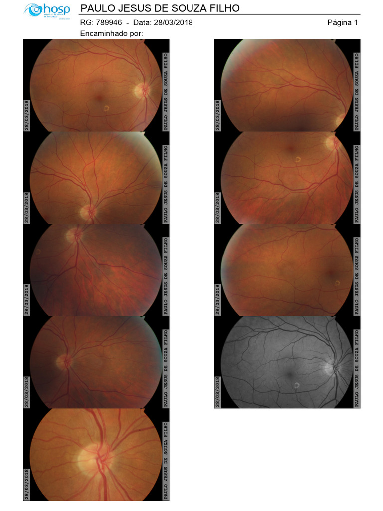 RETINO_OD_28_03_2018 | PDF