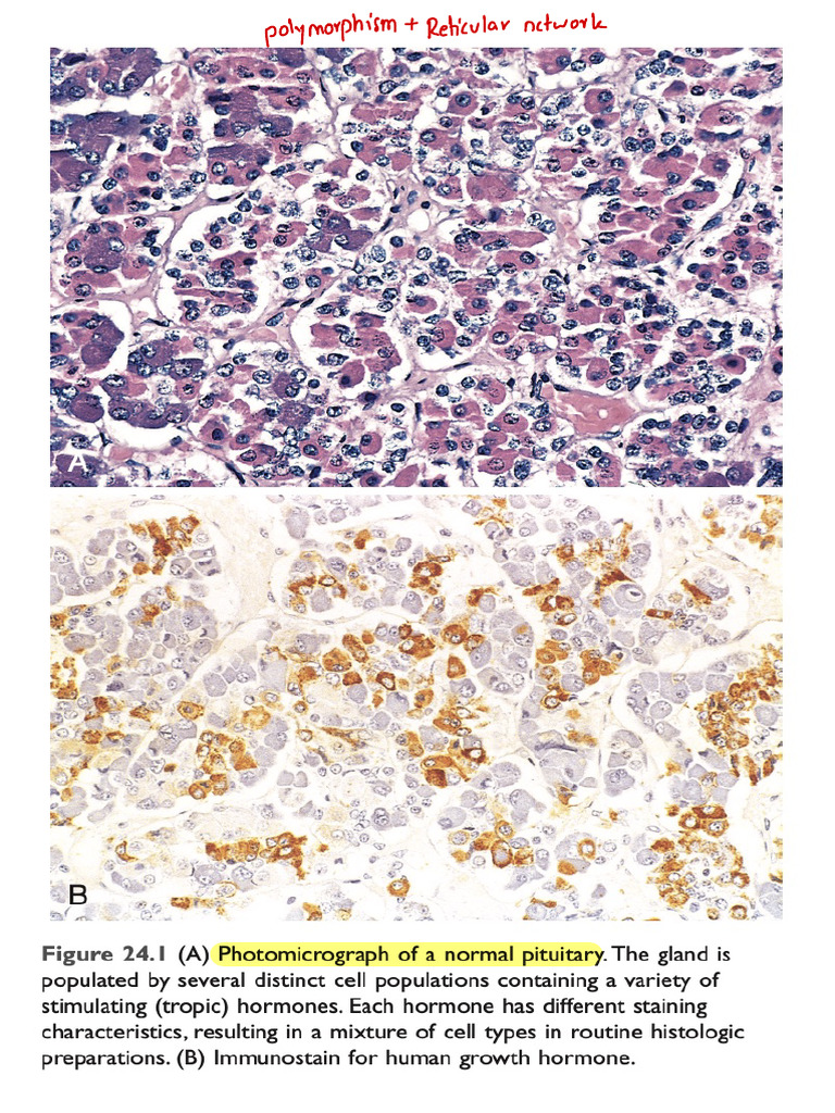 Endocrine Pathology | PDF