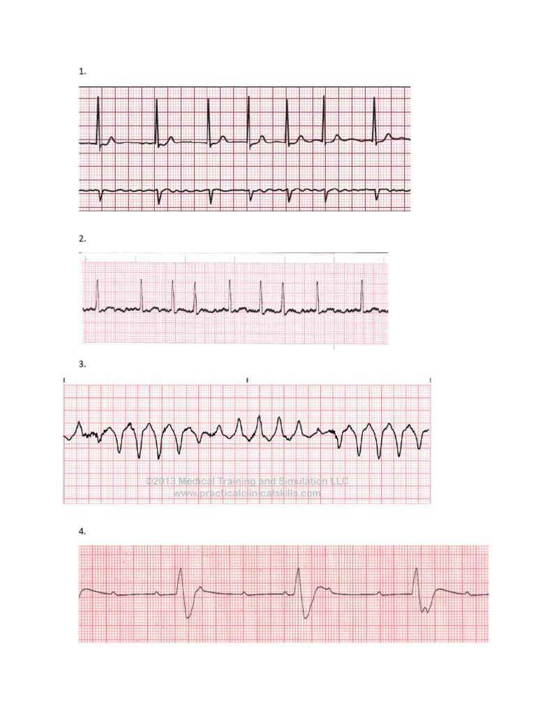 ECG Strips For Interpretation-1 | PDF