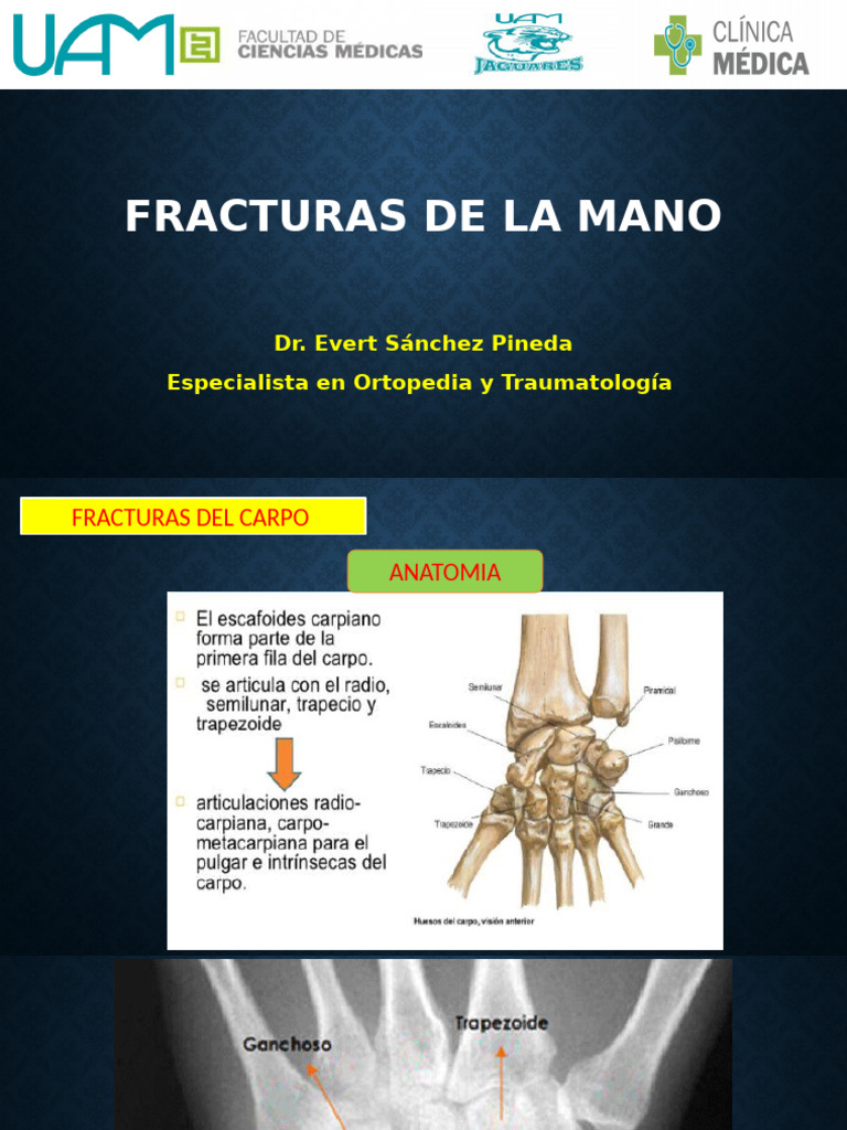 Fracturas de La Mano | PDF | Mano | Sistema musculoesquelético