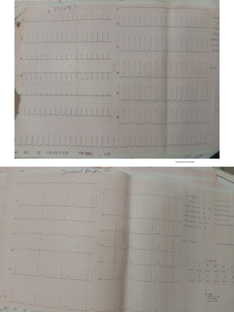 Ward ECG - 250111 - 132826 | PDF