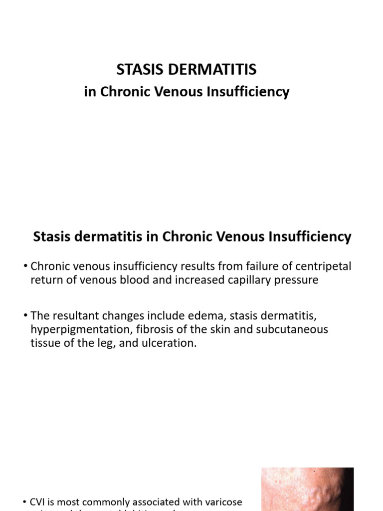Stasis Dermatitis | PDF