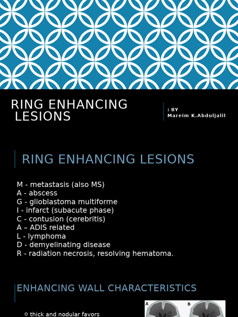 Ring Enhancing Lesions F 2 | PDF | Metastasis | Neoplasms