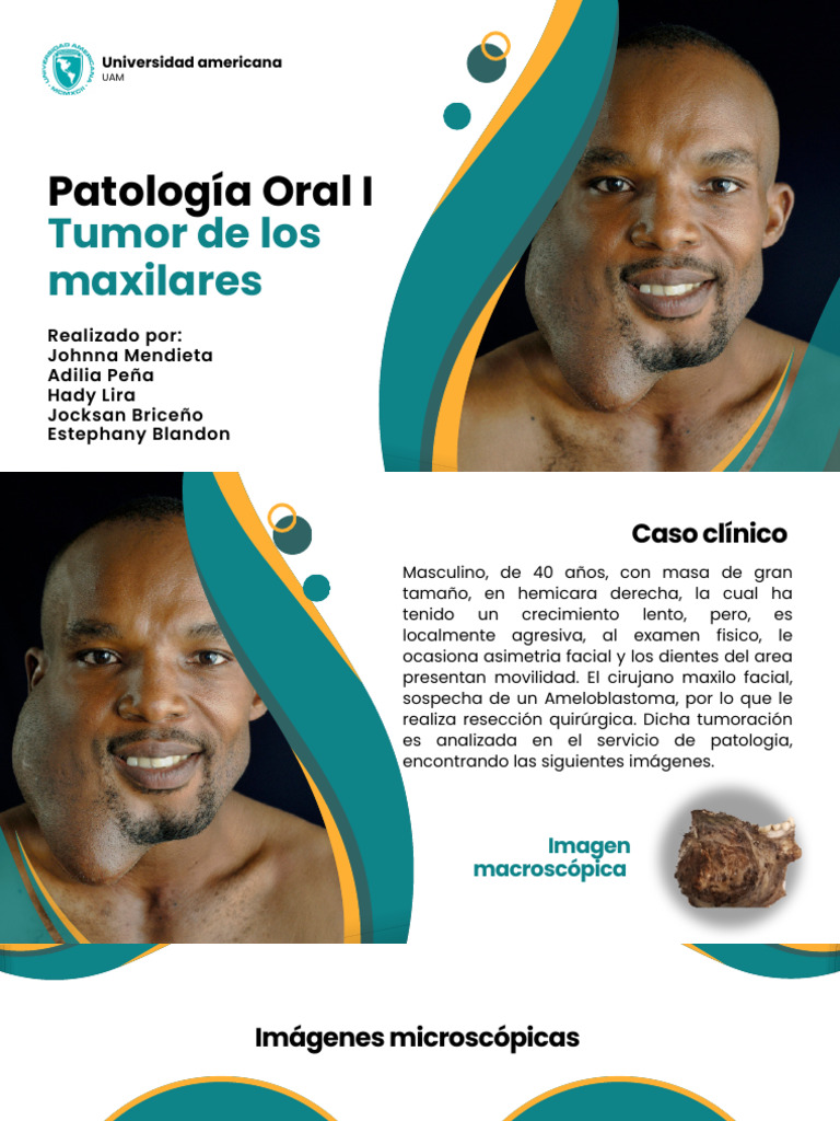 Tumores maxilares - Patología Oral I | PDF | Especialidades Medicas ...
