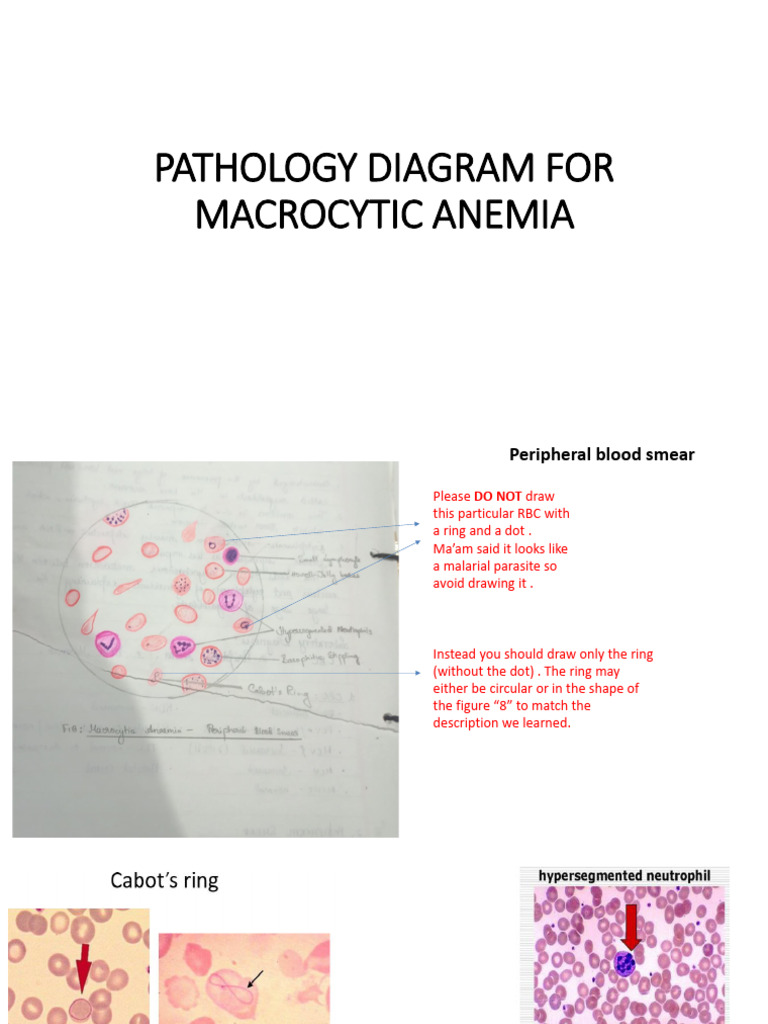 Pathology Diagram For Macrocytic Anemia | PDF