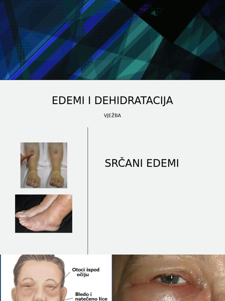 Edemi I Dehidratacija | PDF