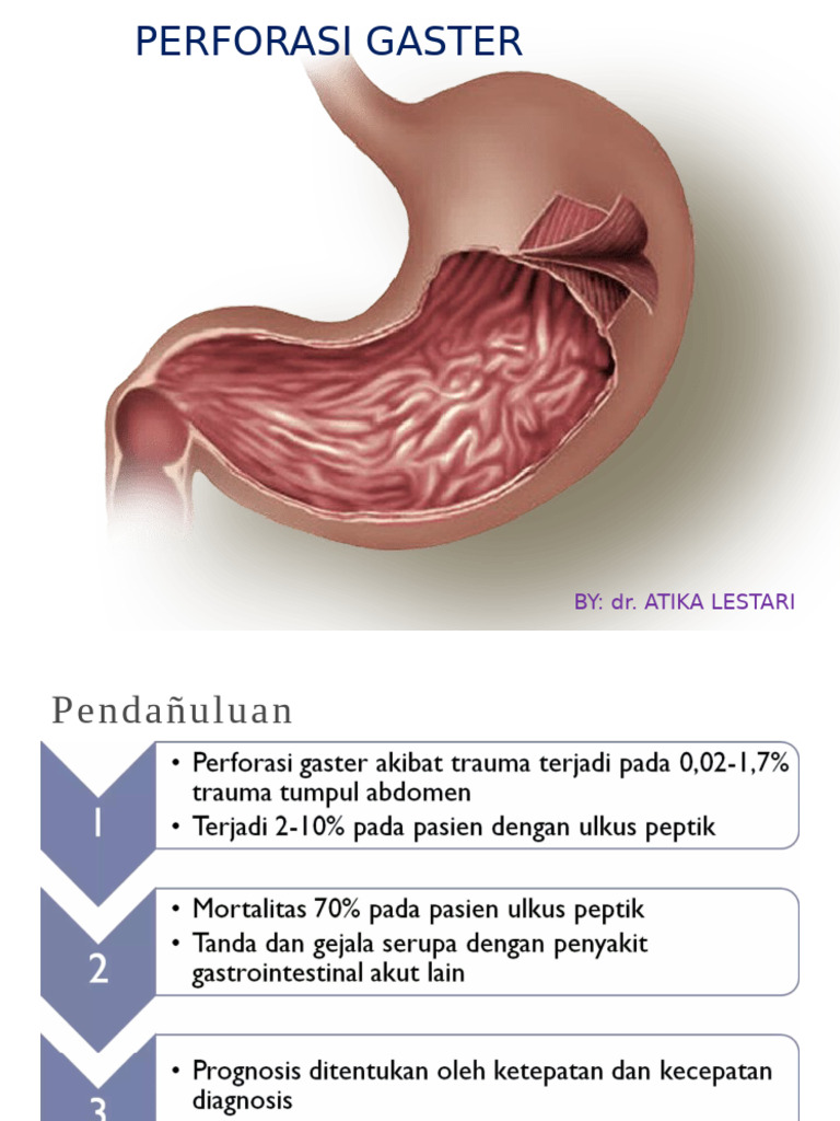 Perforasi Gaster | PDF