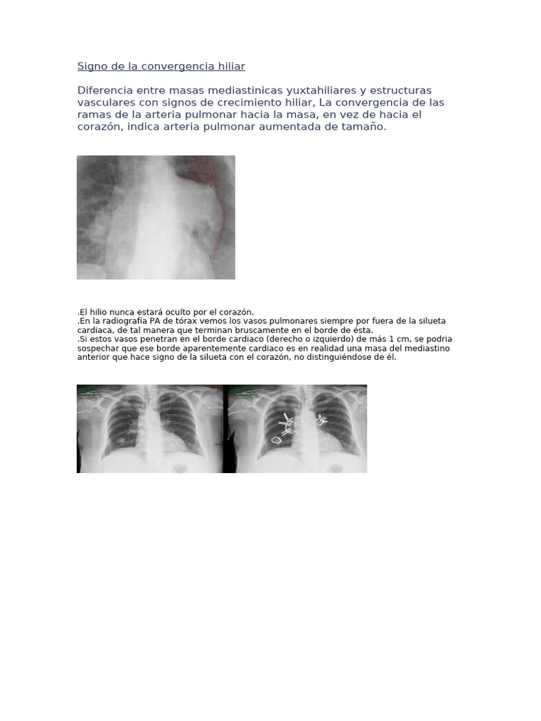 Signo de convergencia hiliar en radiografías | PDF