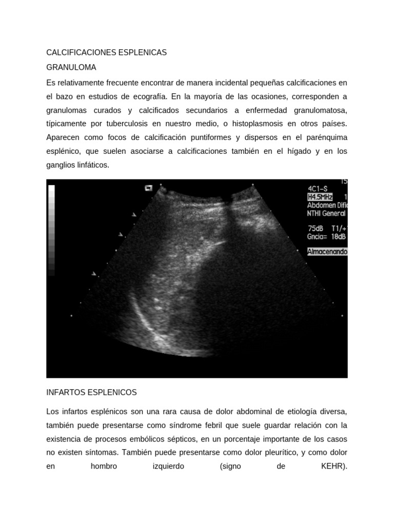 Calcificaciones Esplenicas | PDF | Linfoma | Célula B