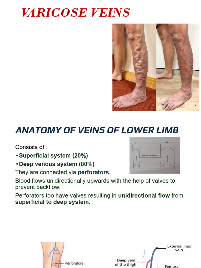 varicose veins anatomy | PDF | Vein | Lower Limb Anatomy