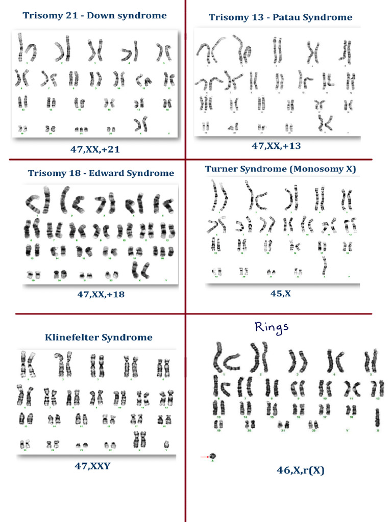 Chromosomal Abnormalities | PDF