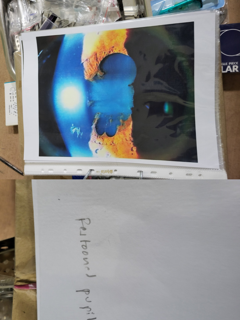 Opthal Spotting | PDF