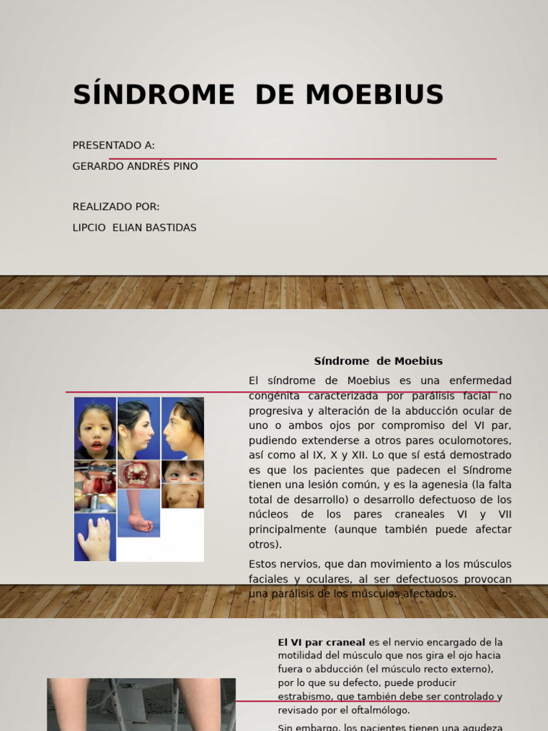 Síndrome de Moebius Elian | PDF | Enfermedades y trastornos | Especialidades Medicas