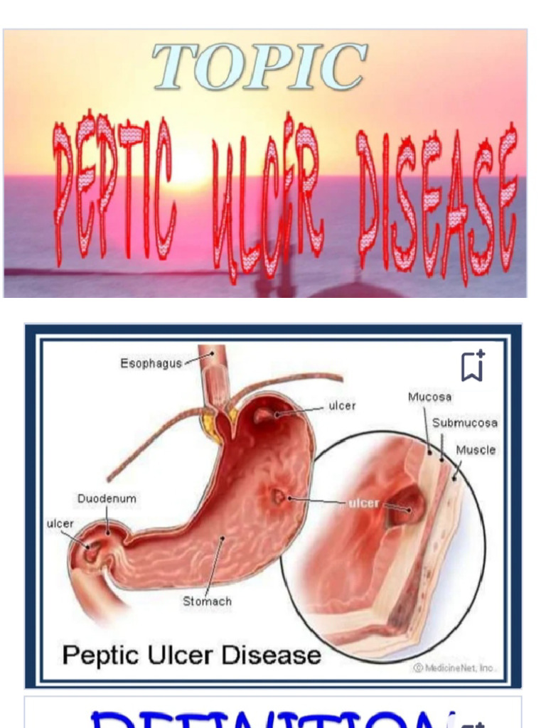 Peptic Ulcer | PDF