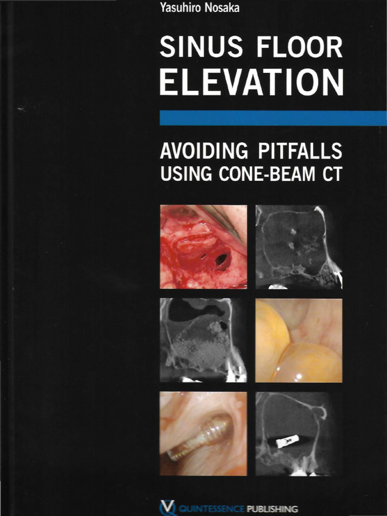 Sample of Sinus Floor Elevation Avoiding Pitfalls Using Cone Beam | PDF ...