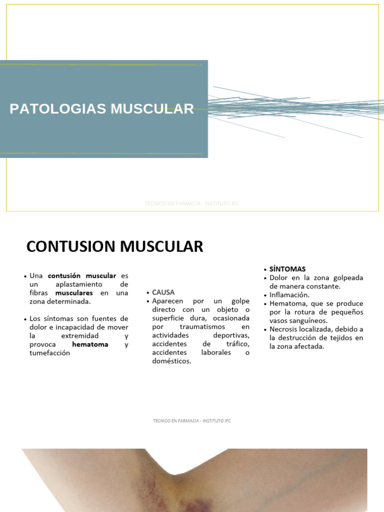 PATOLOGIAS MUSCULAR (4) .PPTX - 20250320 - 140844 - 0000 | PDF | Droga ...