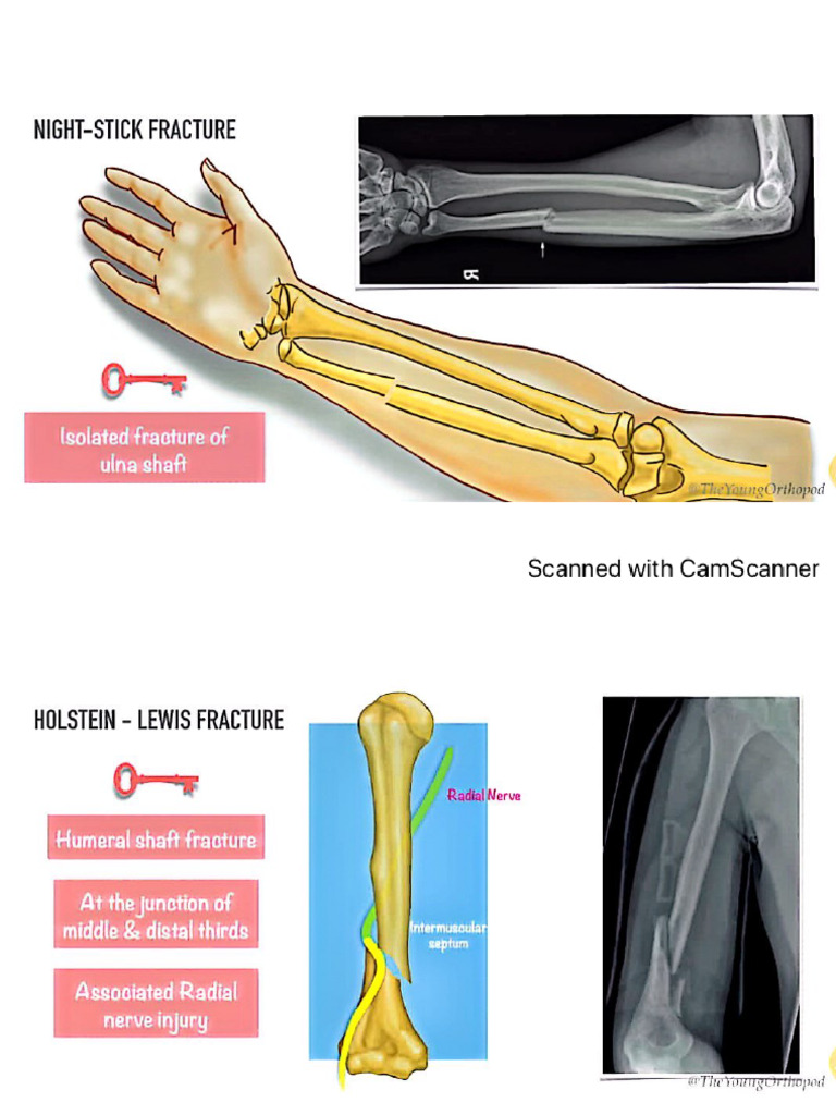 Fractures of Upper Limb. | PDF