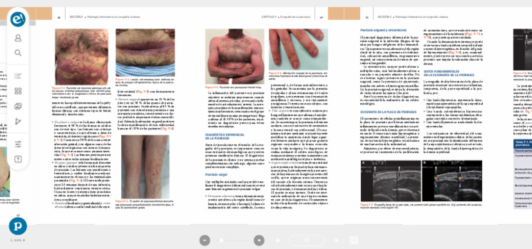 Figs. 9-7A 9-7B: Psoriasis Ungueal y Onicomicosis | PDF | Medicina CLINICA | Enfermedades y ...