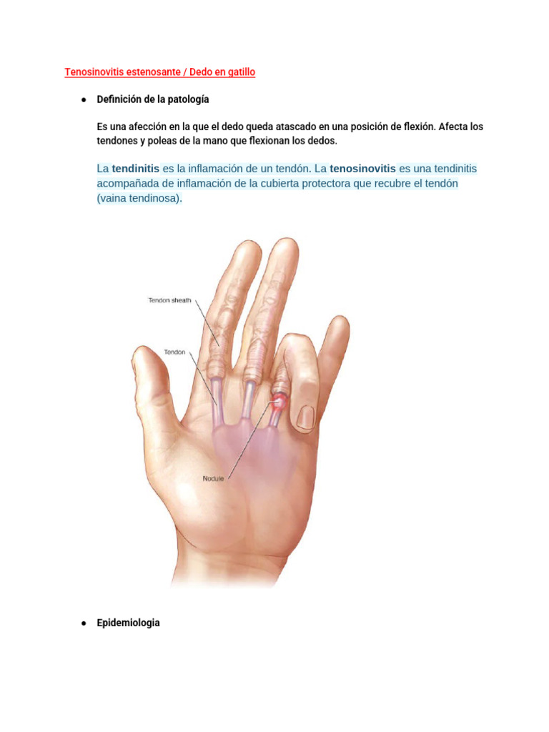 Dedo en Gatillo: Causas y Tratamiento | PDF | Medicina | Enfermedades y ...