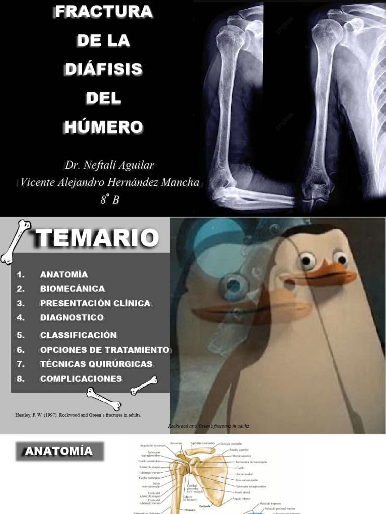 Fractura de diáfisis del húmero: guía completa | PDF | Codo | Sistema ...