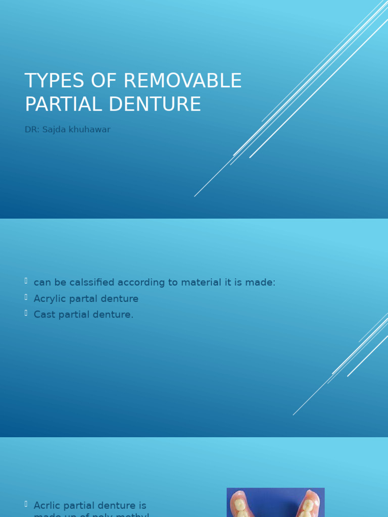 Types of Removable Partial Dentures | PDF | Dentures | Dentistry Branches