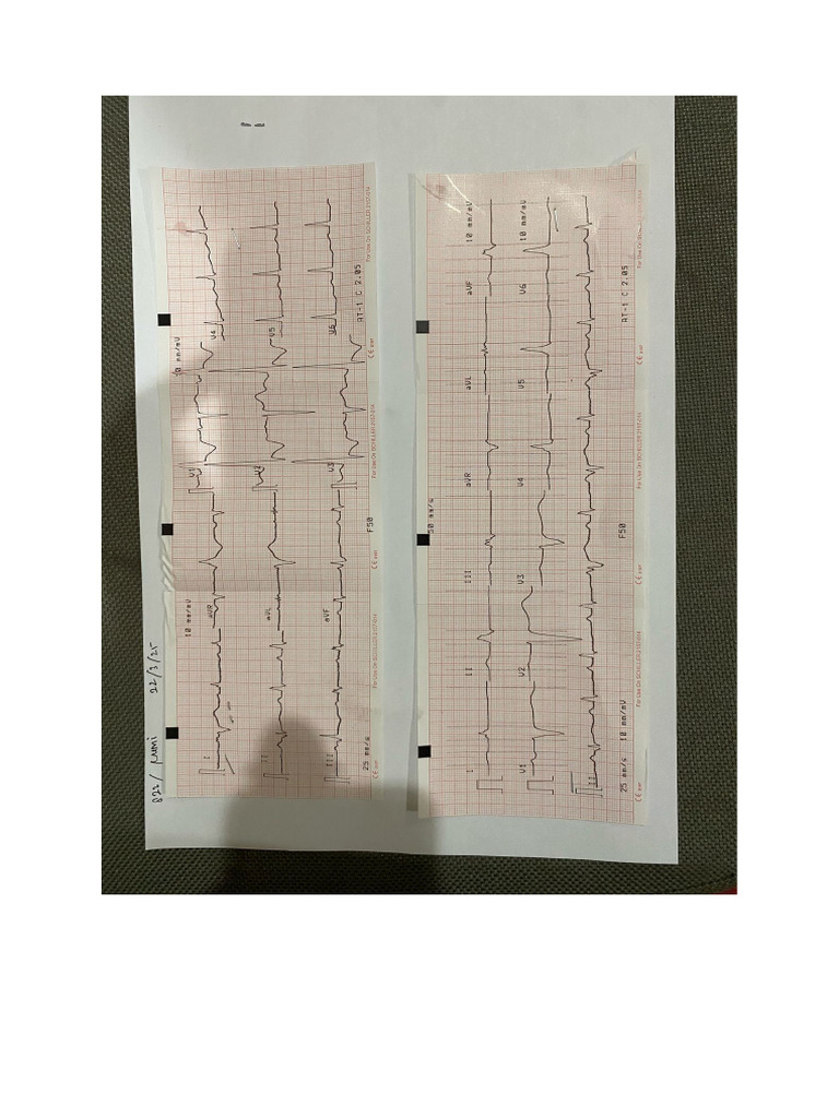 Ekg 1 | PDF