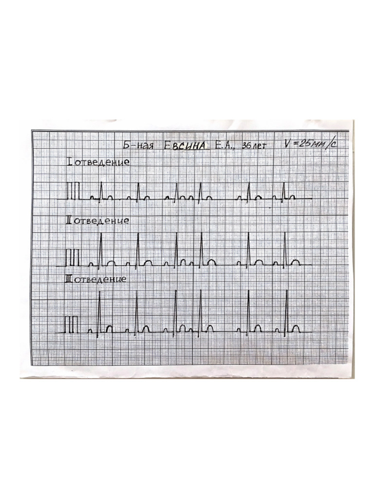 Ecg 8. | PDF