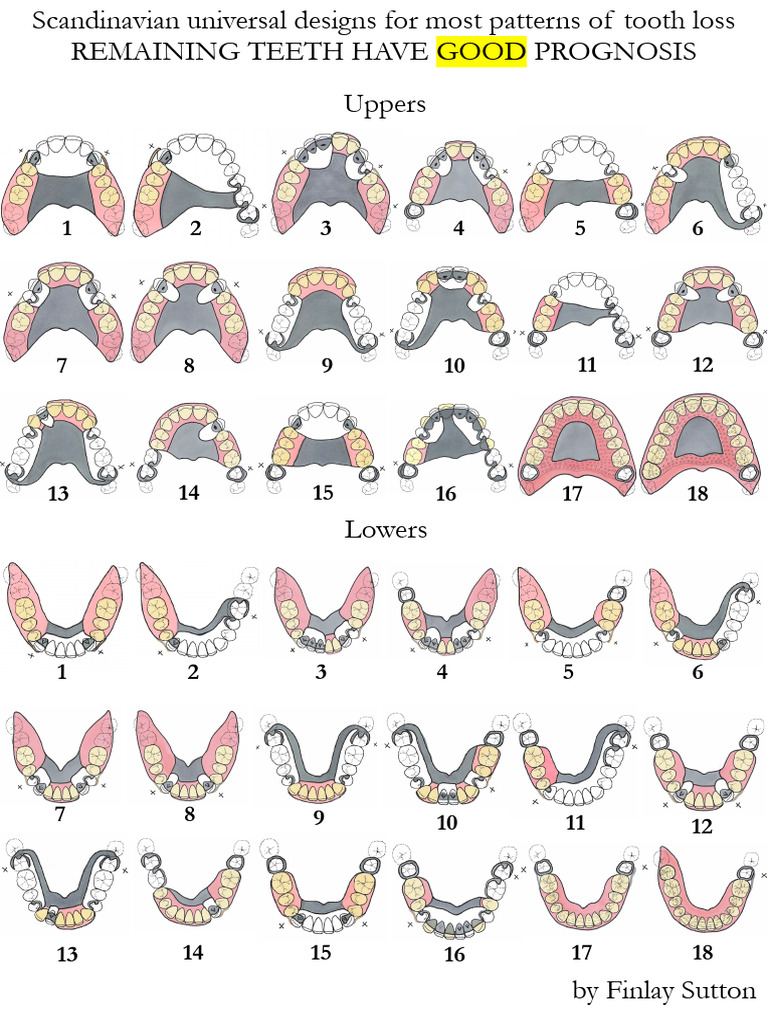 RPD Unversal Designs | PDF